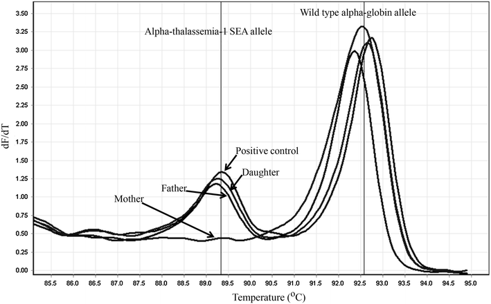Hemoglobin Constant Spring (Hb CS) Missed by HPLC in an Hb E Trait ...