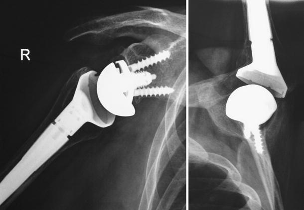 Reverse total shoulder arthroplasty: radiological and clinical result ...