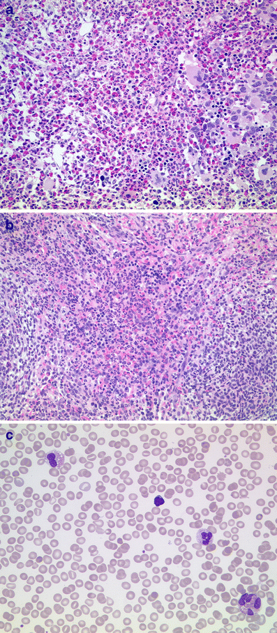 Eosinophil, basophil, and mast cell infiltrates in the bone marrow ...