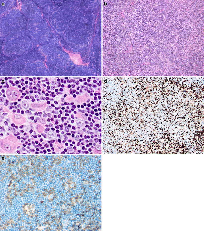 Thomas Hodgkin and Hodgkin lymphoma | SpringerLink