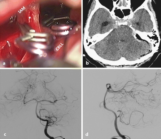 Ruptured Intrameatal Aneurysm of the Anterior Inferior Cerebellar ...