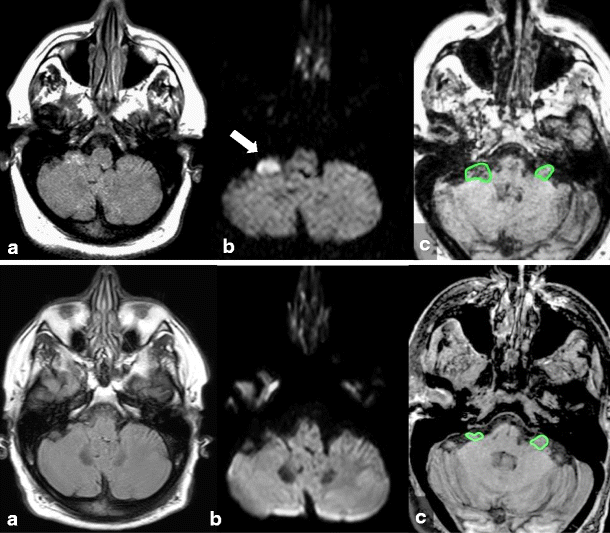 The Floccular Syndrome: Dynamic Changes in Eye Movements and Vestibulo ...