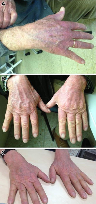 Pirfenidone in Idiopathic Pulmonary Fibrosis: Expert Panel Discussion ...