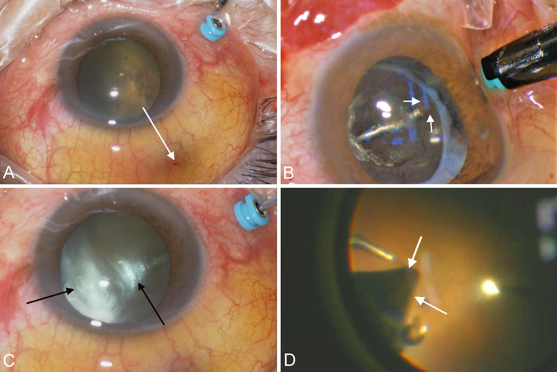Systemic Approach to Prevent Inadvertent Perfusion in Eyes with ...