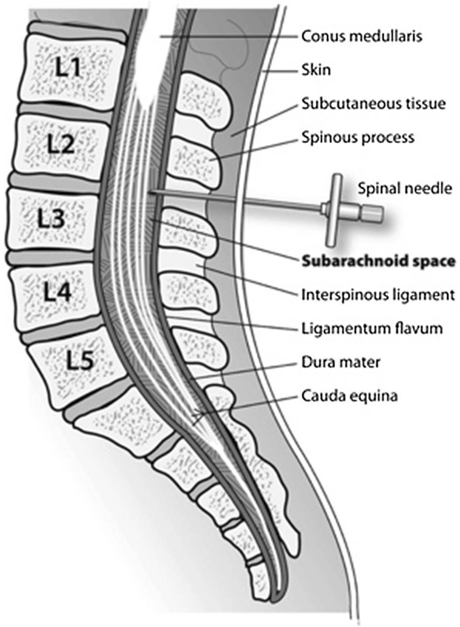 Epidural Corticosteroids, Lumbar Spinal Drainage, and Selective ...