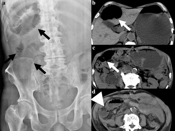 Bowel strangulation caused by massive intraperitoneal adhesion due to ...