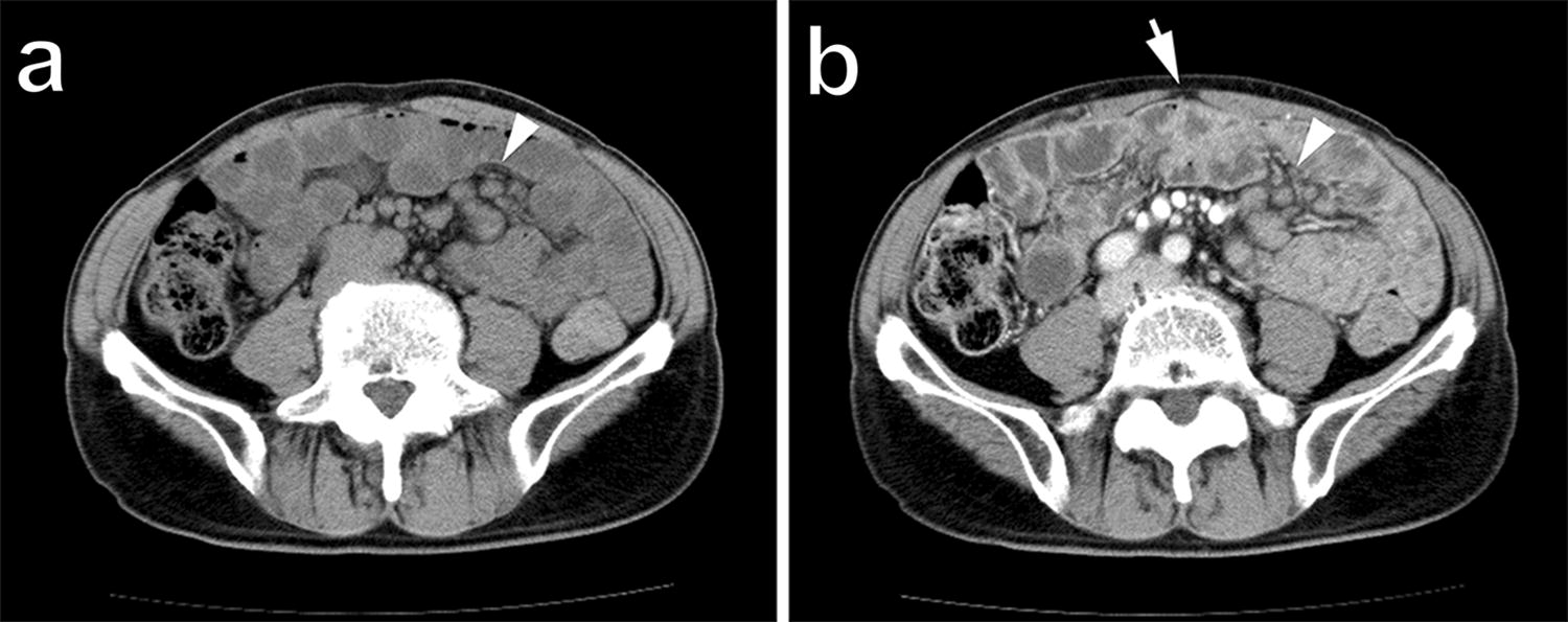 Indolent T cell lymphoproliferative disorder with villous atrophy in ...