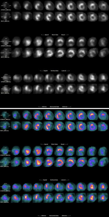 SPECT attenuation artifact in a patient with a subcutaneous implantable ...
