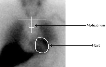 ASNC imaging guidelines for SPECT nuclear cardiology procedures: Stress ...