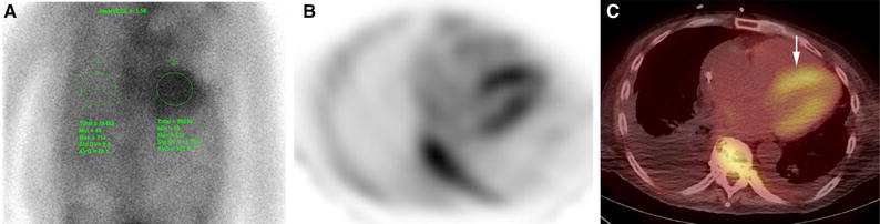 Nuclear imaging of cardiac amyloidosis | SpringerLink