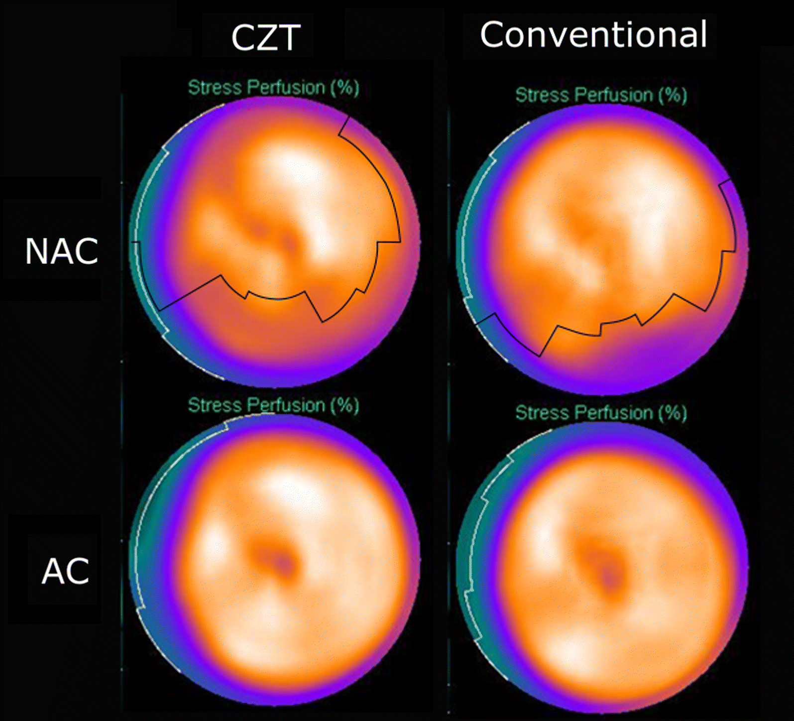 Differences in attenuation pattern in myocardial SPECT between CZT and ...