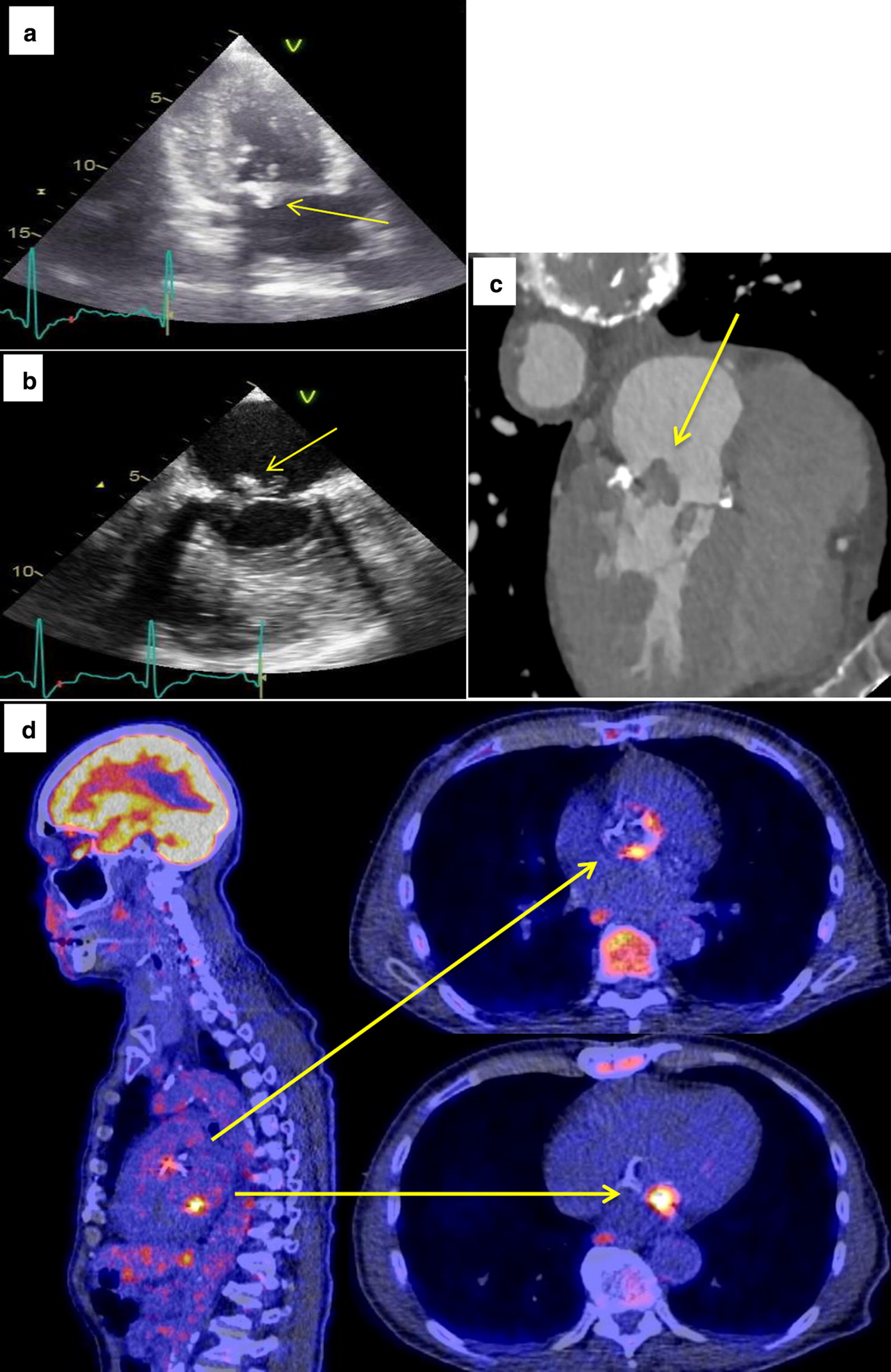 Imaging infective endocarditis: Adherence to a diagnostic flowchart and ...
