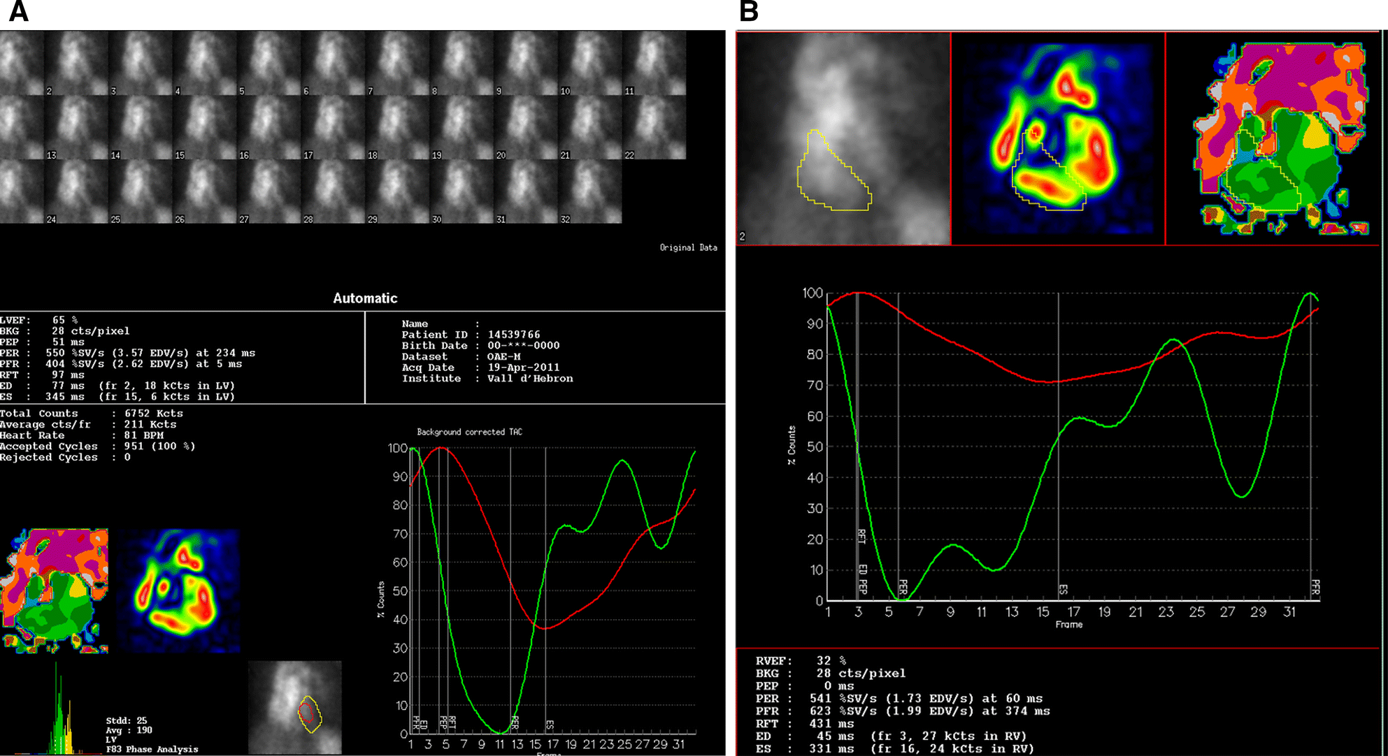 Equilibrium radionuclide angiography: Present and future | SpringerLink
