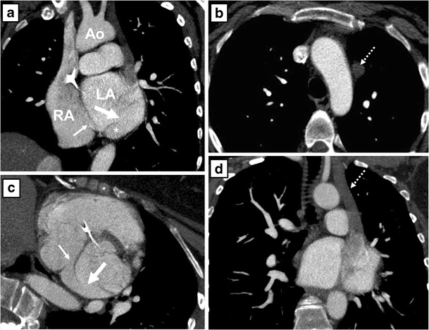 Unroofed coronary sinus newly diagnosed in adult patients after ...