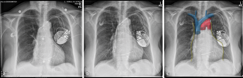 Twiddler syndrome mimicking an abdominal aortic aneurysm | SpringerLink
