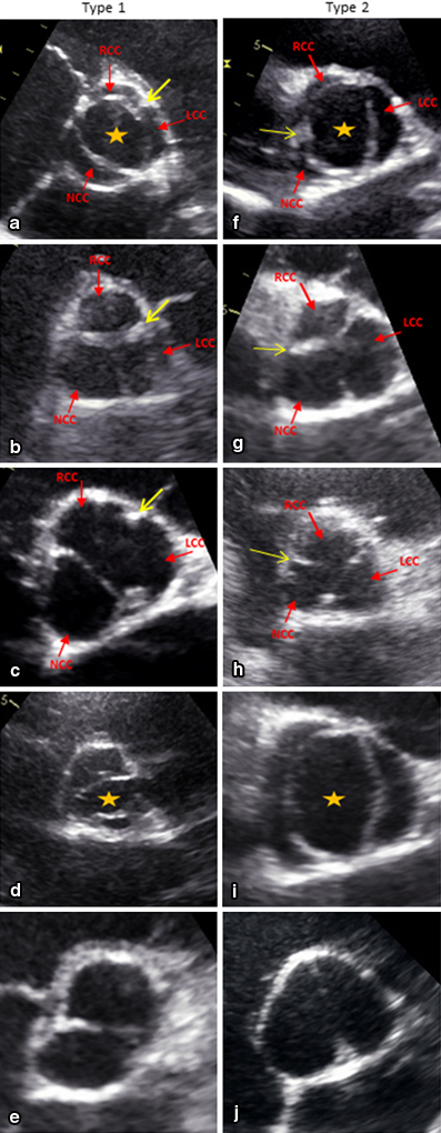 The extent of the raphe in bicuspid aortic valves is associated with ...