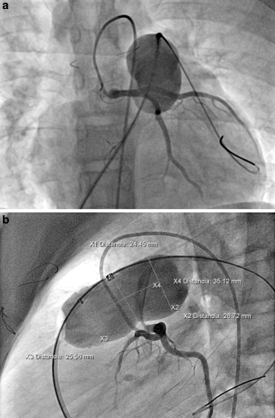 Early experience with the Venus p‑valve for percutaneous pulmonary ...