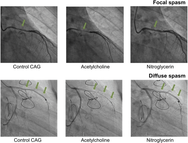 Long-term outcomes of a Caucasian cohort presenting with acute coronary ...