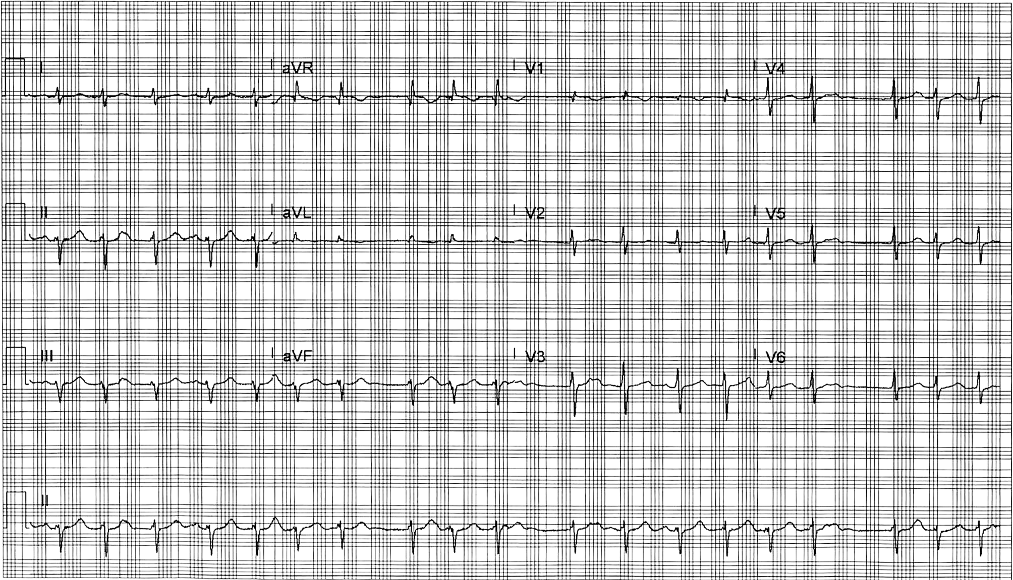 An irregular narrow complex tachycardia: atrial fibrillation or ...