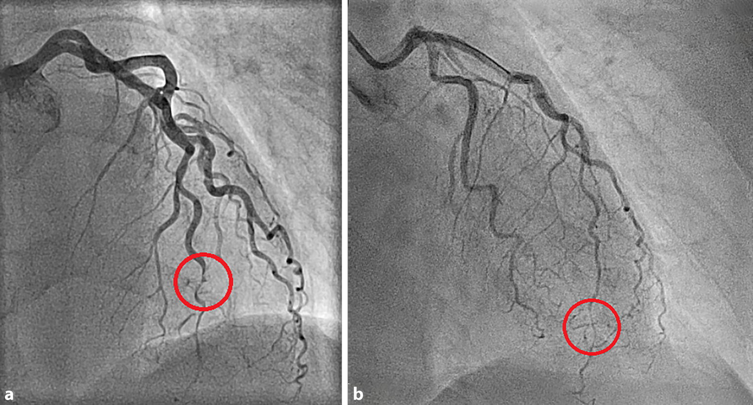Epicardial coronary spasm due to endothelial dysfunction after ...