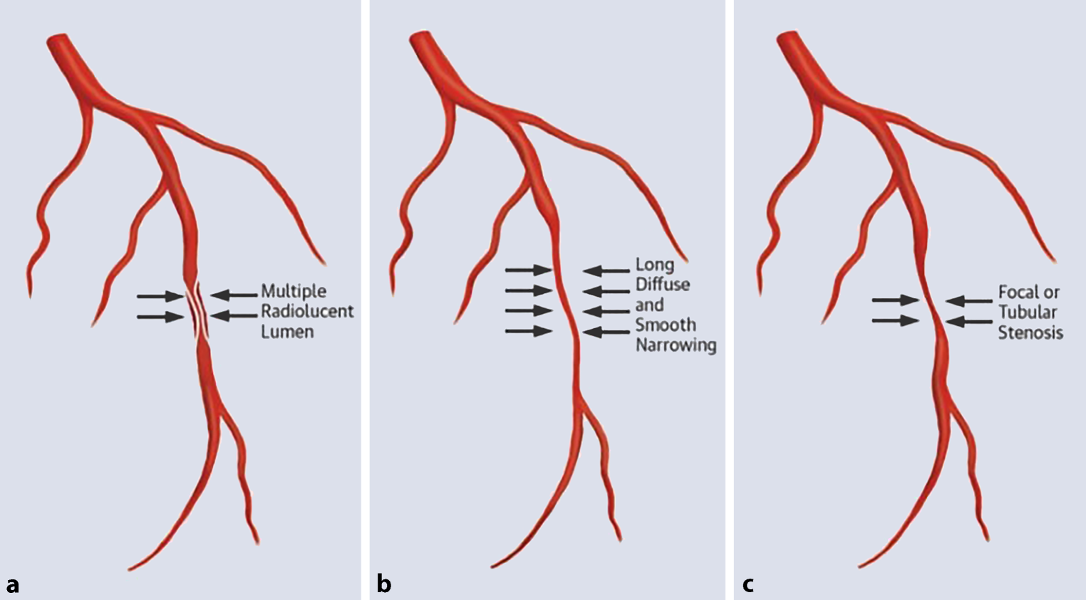 Spontaneous coronary artery dissections and associated predisposing ...