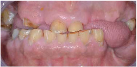 Gouden tand bij telescoopframe | SpringerLink