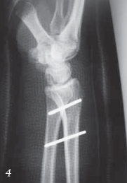 Distale radio-ulnaire luxatie | SpringerLink