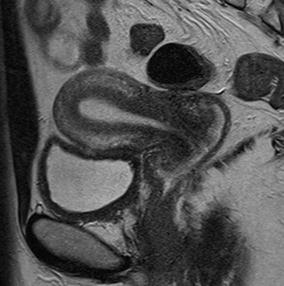 Uterine anatomy and function on cine magnetic resonance imaging ...