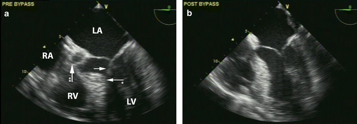 Surgery for hypertrophic cardiomyopathy | SpringerLink