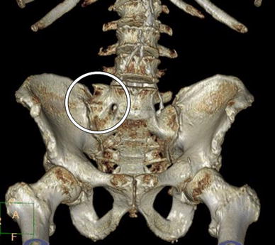 The association between sacralization and spondylolisthesis | SpringerLink