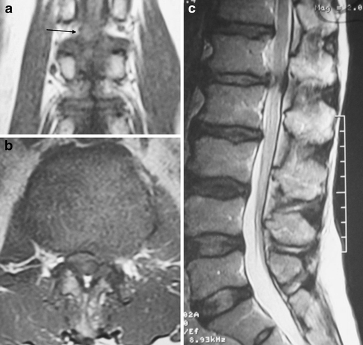 Detailed clinical characteristics of L1–2 disc herniation—a new ...