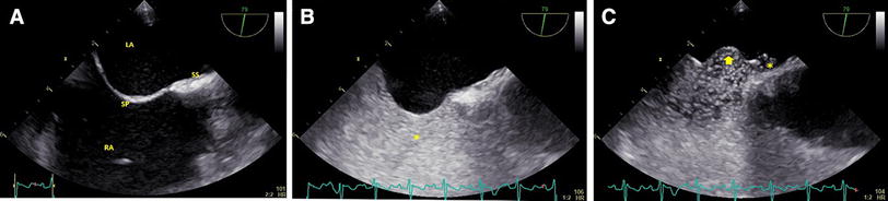 Valsalva maneuver in echocardiography | SpringerLink