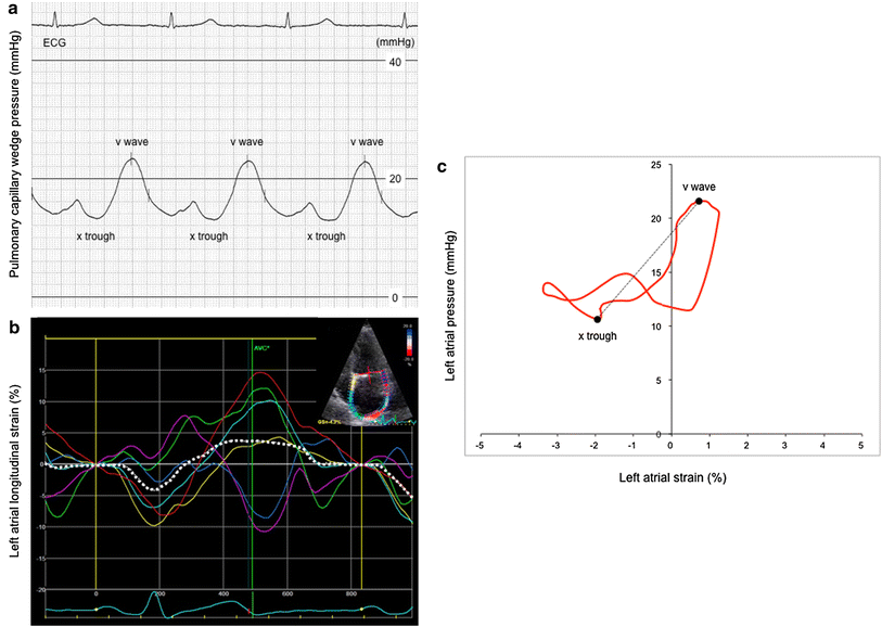 Prominent v wave as a result of left atrial stiffening | SpringerLink