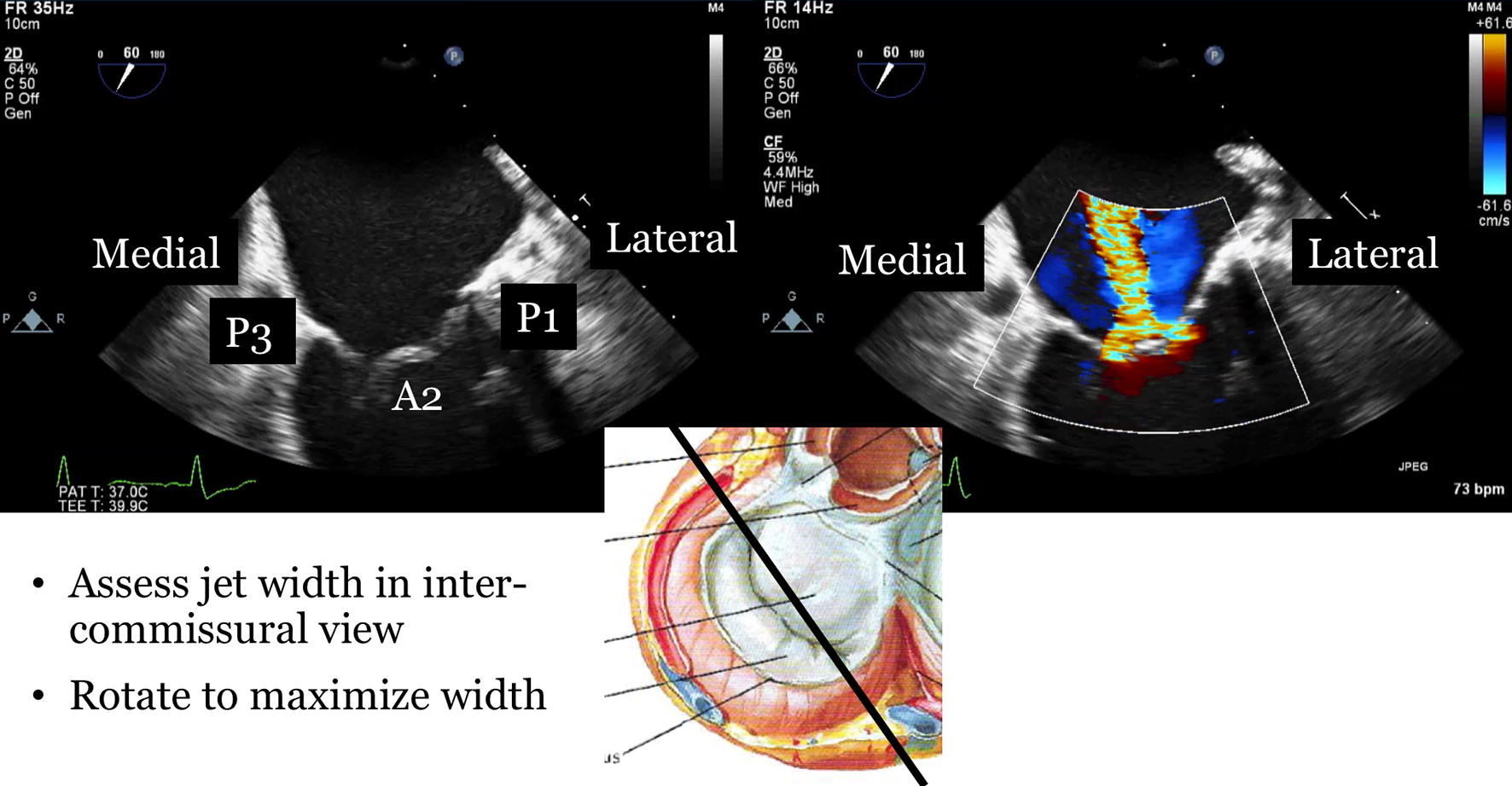 Echocardiographic guidance for transcatheter mitral valve repair using ...