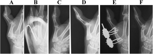 Correction of a Hyperextension Deformity at the Metacarpophalangeal ...