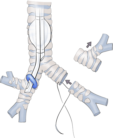 The clinical use of right-sided double-lumen tubes | SpringerLink