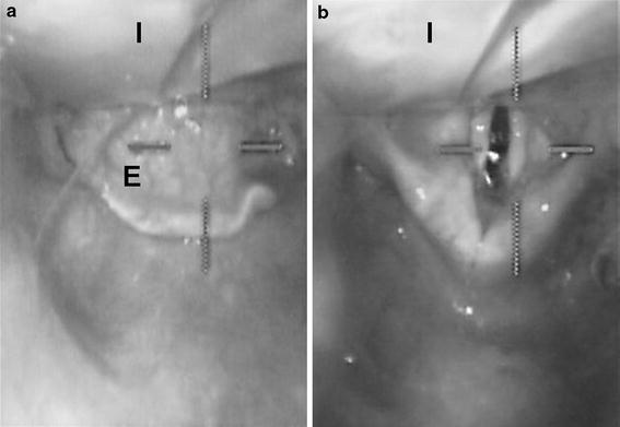 The “jaw thrust” maneuver rather than the “BURP” maneuver improves the ...