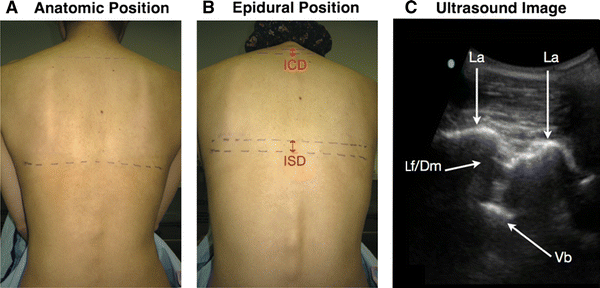 Identification of cervicothoracic intervertebral spaces by surface ...