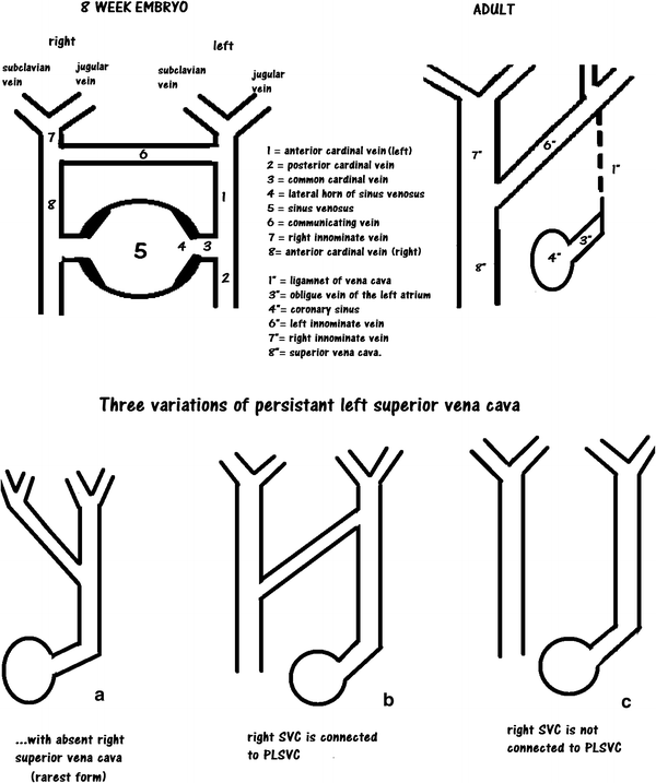 Persistent left superior vena cava: implications during central venous ...