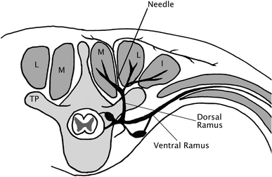 Thoracolumbar interfascial plane (TLIP) block: a pilot study in ...