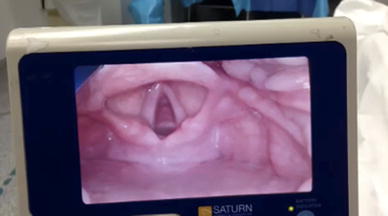 A deliberately restricted laryngeal view with the GlideScope® video ...