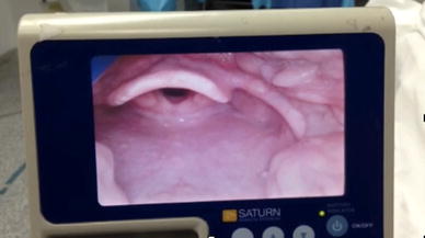 A deliberately restricted laryngeal view with the GlideScope® video ...