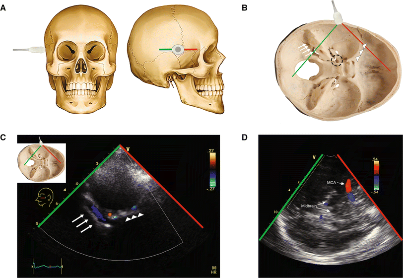 Transcranial Doppler monitoring guided by cranial two-dimensional ...