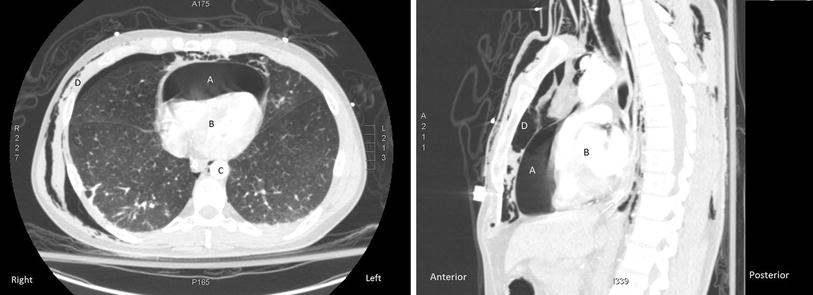 Massive pneumopericardium | SpringerLink