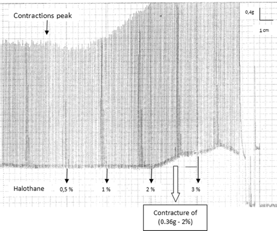 Idiopathic hyperCKemia and malignant hyperthermia susceptibility ...