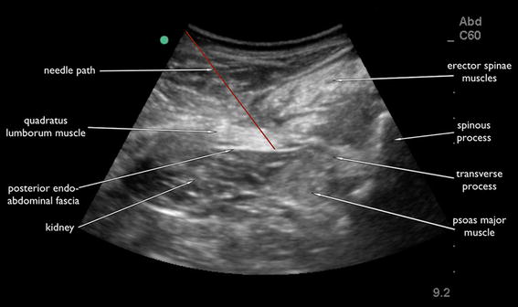 Ultrasound-guided lateral-medial transmuscular quadratus lumborum block ...