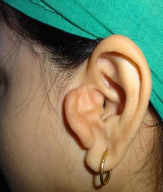 An Extremely Rare Case of Accessory Auricle, Polyotia and its Surgical ...