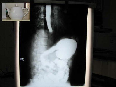 Tea pot stomach | SpringerLink