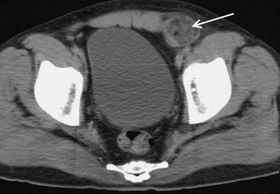 Left sided omental torsion with left inguinal hernia: a rare entity ...