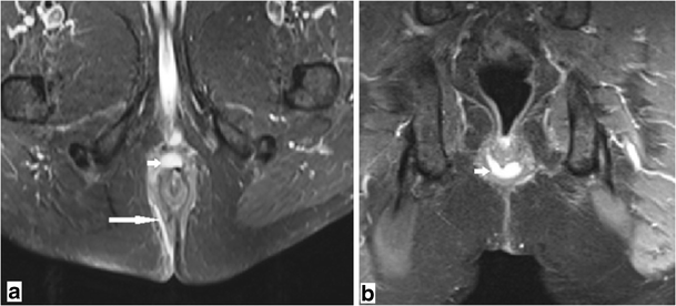 Magnetic resonance imaging in perianal fistulas—A pictorial atlas ...